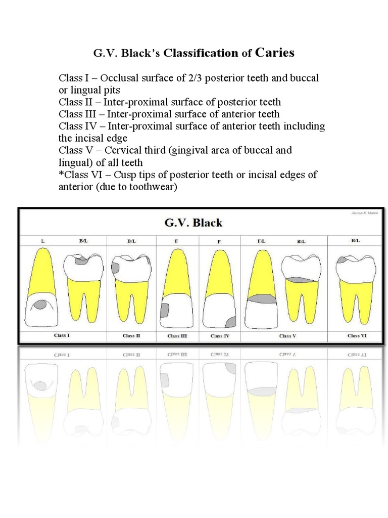 G.V Black Caries Classification | PDF