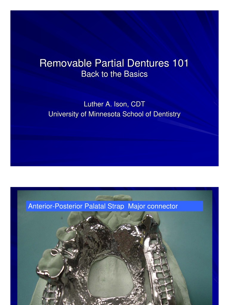 RPD Basics | PDF | Dentures | Mouth