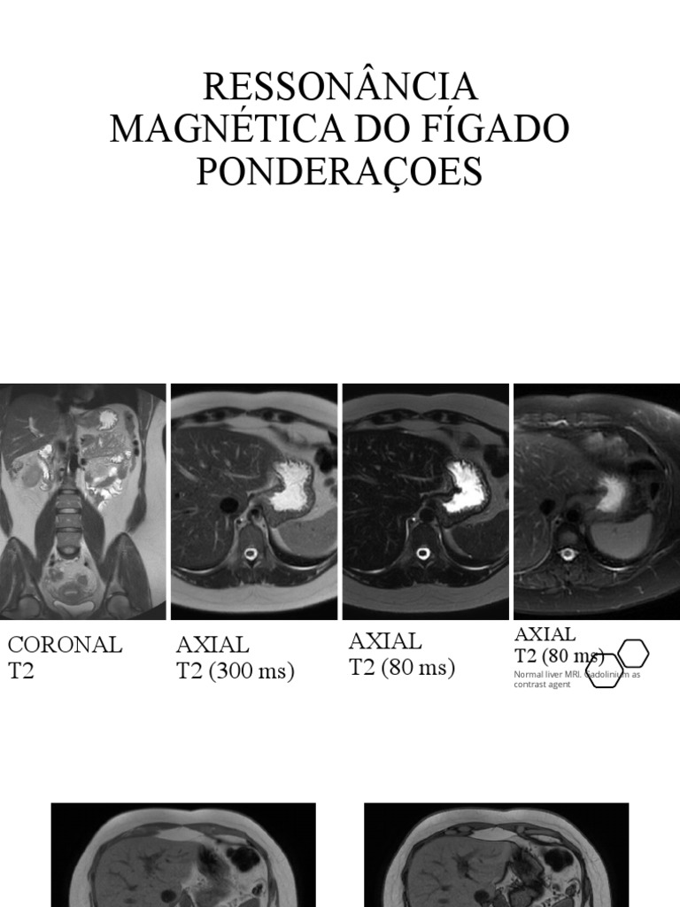 Ressonância Magnética Do Fígado Normal | PDF | Imagem de ressonância ...