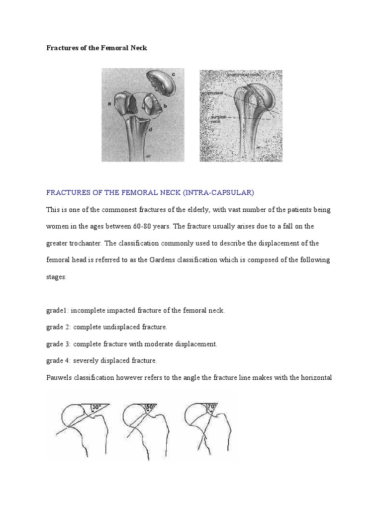Femoral Neck Fractures: Types & Treatment | PDF | Hip | Musculoskeletal ...