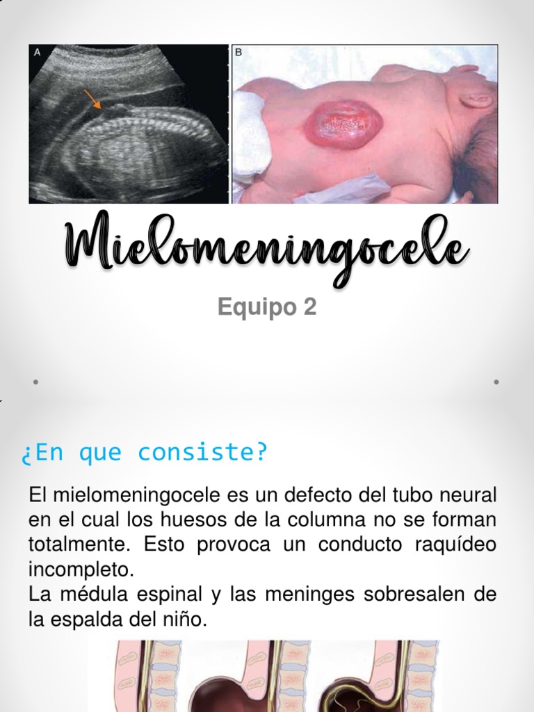 Mielomeningocele | PDF
