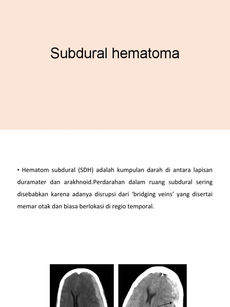 Perbedaan-Letak Lesi-Sdh-Edh-Ich-Ivh-Sah | PDF