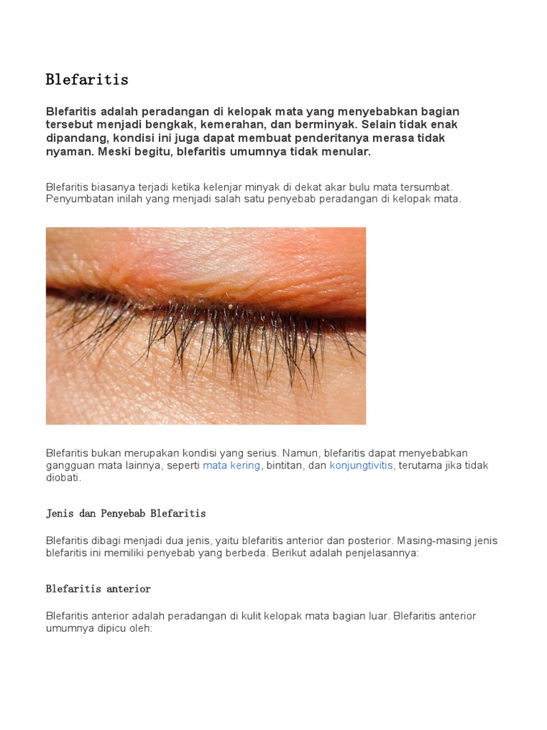 Blefaritis | PDF