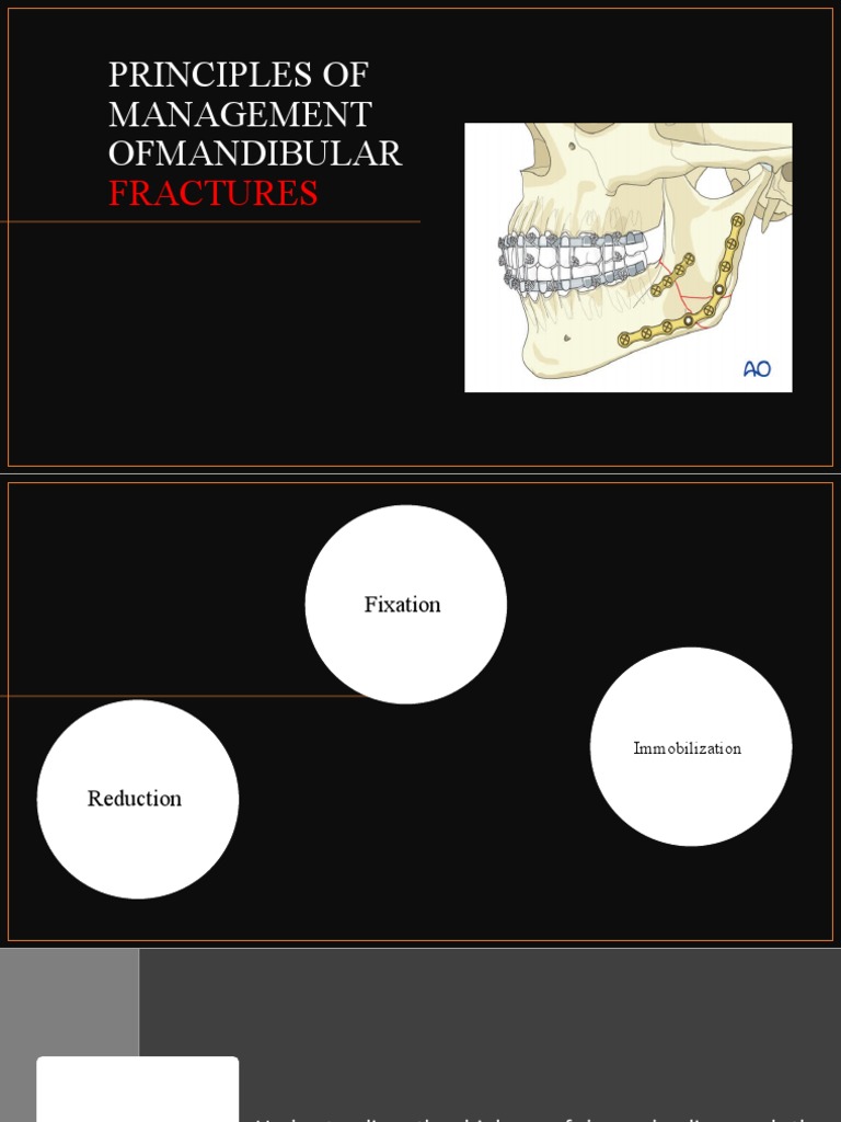 Mandibular Fracures - Closed Reduction | PDF | Bone | Healing