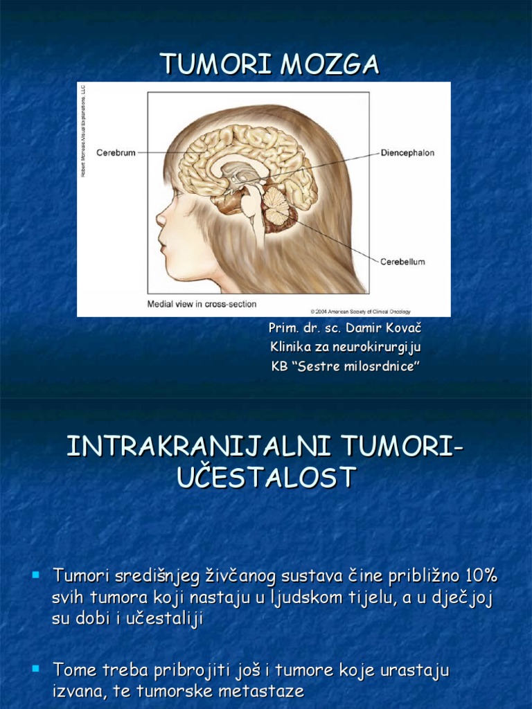 Tumori Mozga | PDF