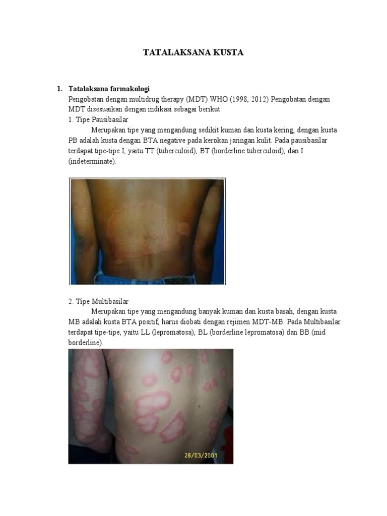 Tatalaksana Kusta | PDF