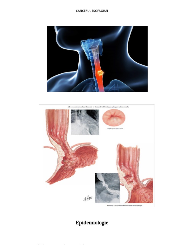 Cancerul Esofagian | PDF