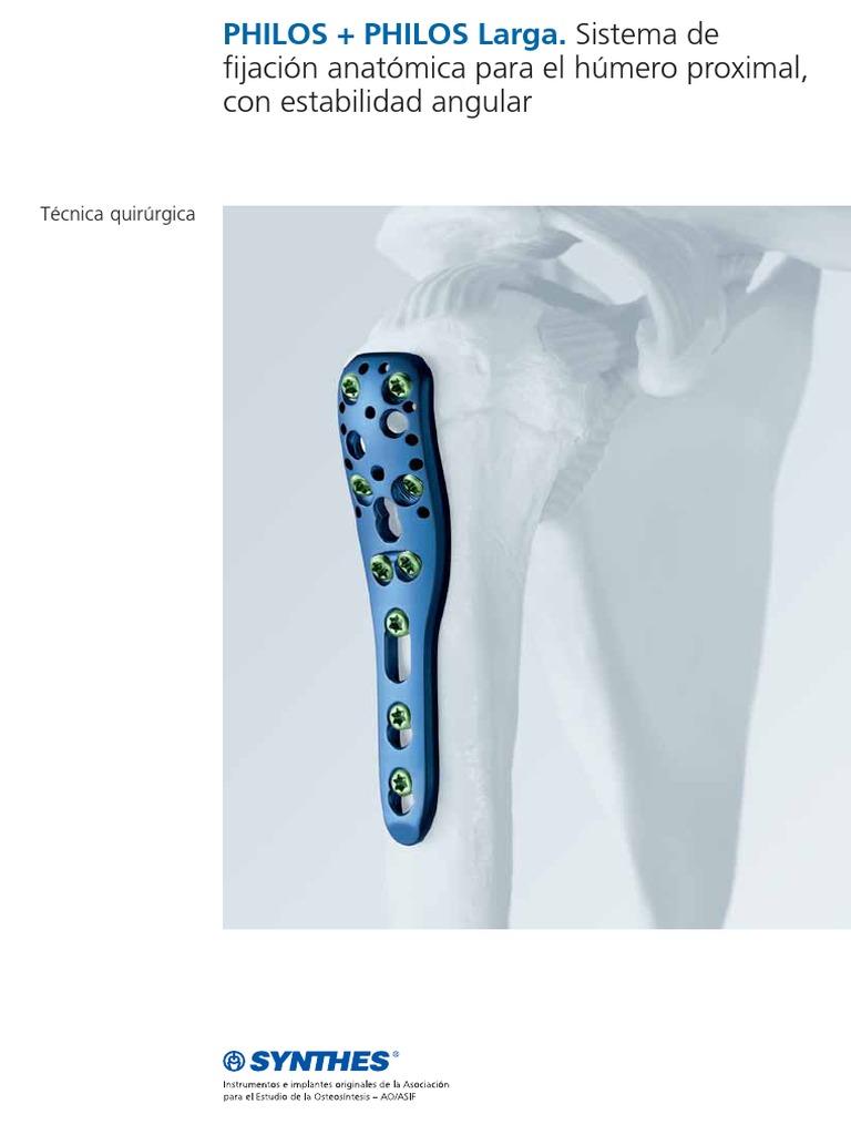 Placa Philos Técnica Cirúrgica | PDF | Tornillo | Cirugía