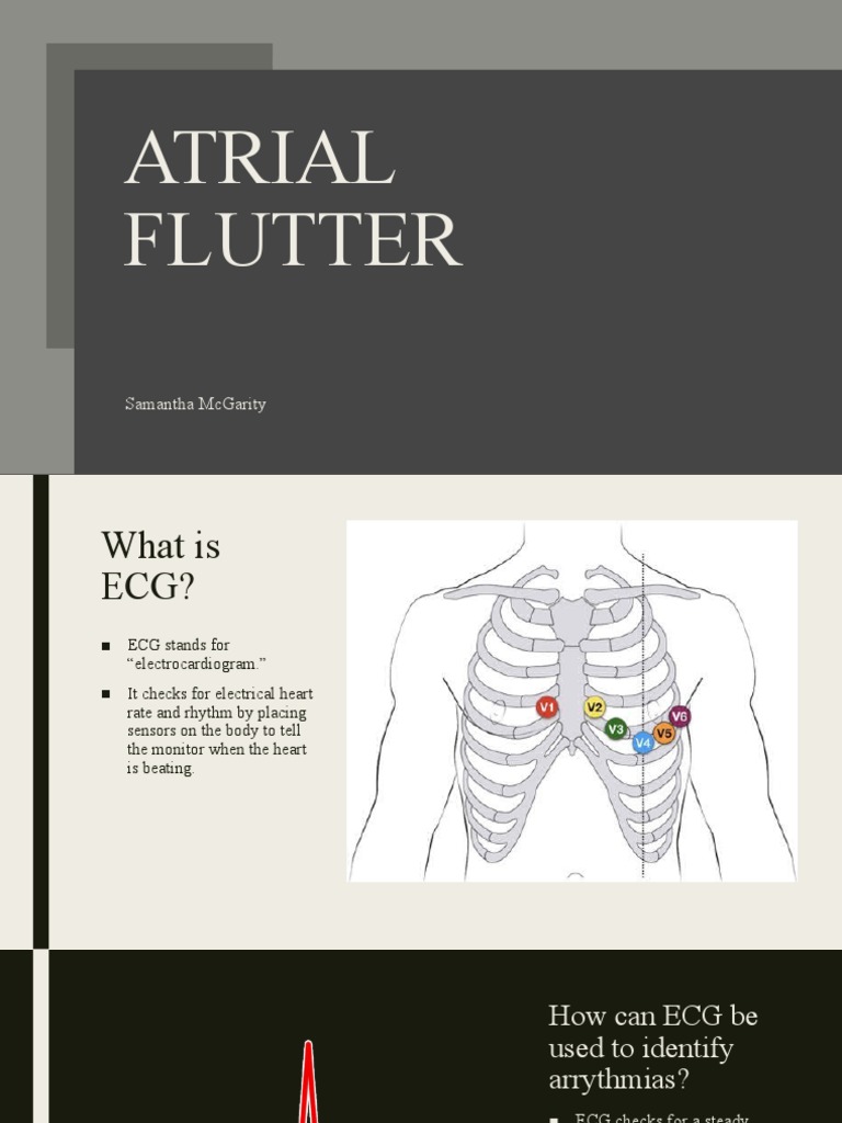 Atrial Flutter | PDF | Electrocardiography | Heart