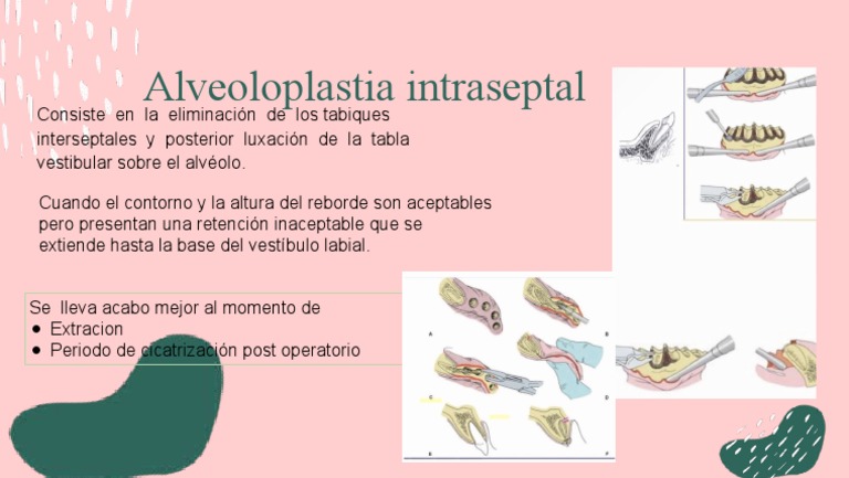 Alveoloplastia Intraseptal | PDF