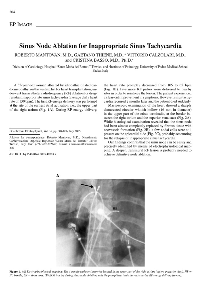 Sinus Node Ablation For Inappropriate Sinus Tachycardia (Mantovan ...