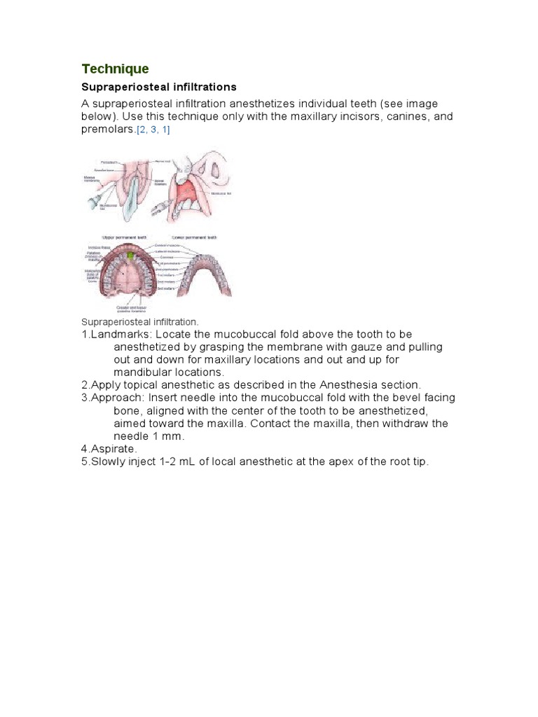 Technique: Supraperiosteal Infiltrations | PDF | Face | Mouth