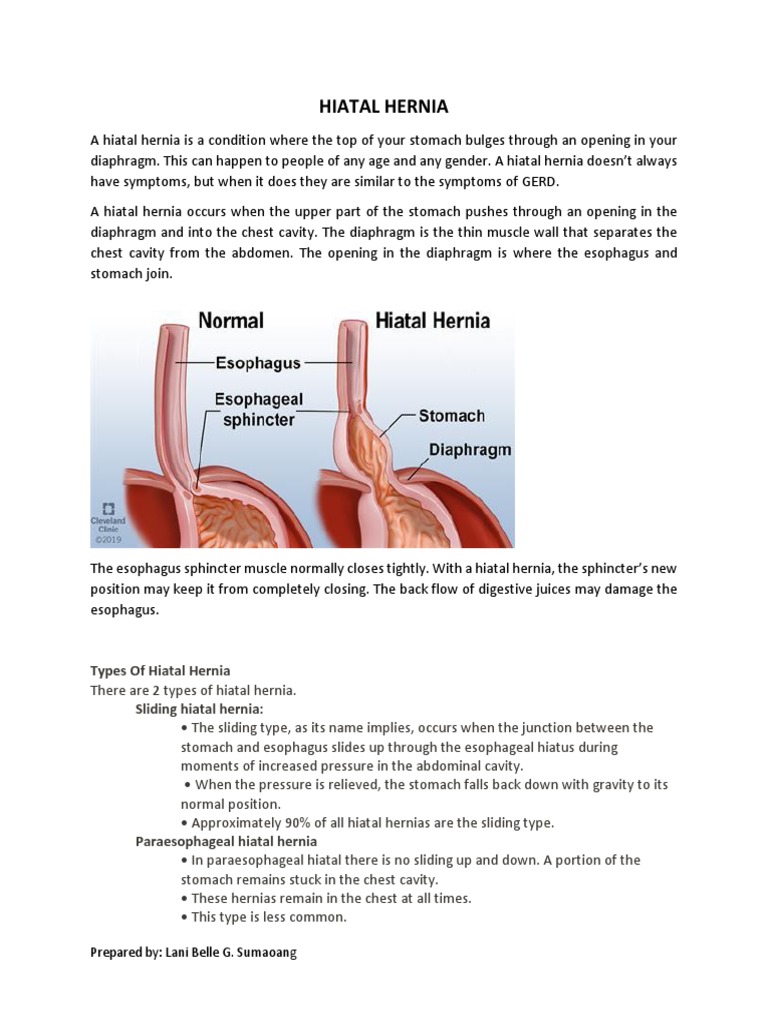 Hiatal Hernia Factsheet | PDF | Gastroesophageal Reflux Disease | Esophagus