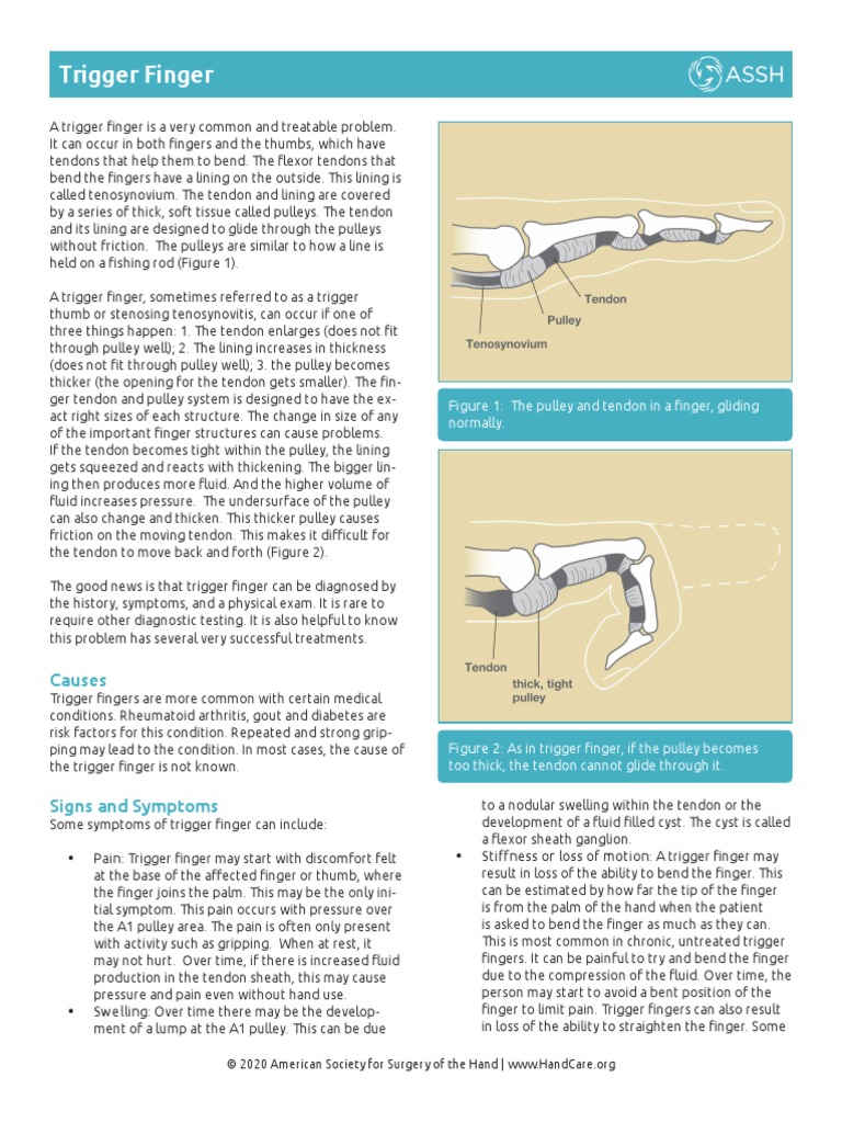 Trigger Finger | PDF | Finger | Hand