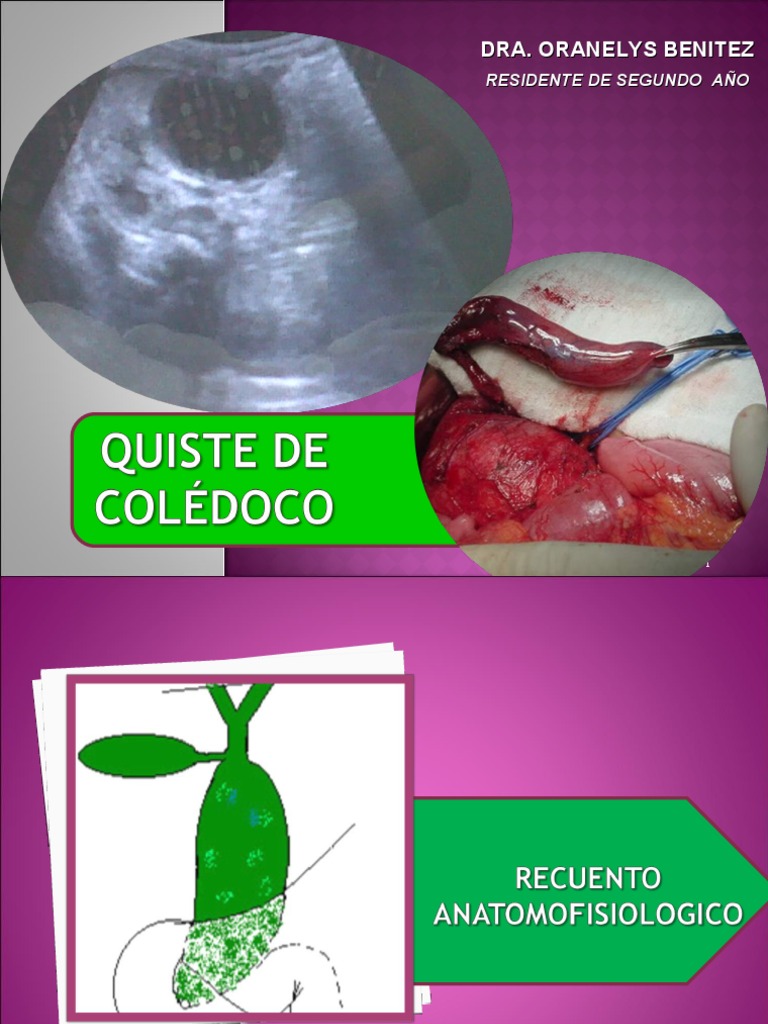 Quiste de Coledoco | PDF | Enfermedades digestivas | Sistema exocrino