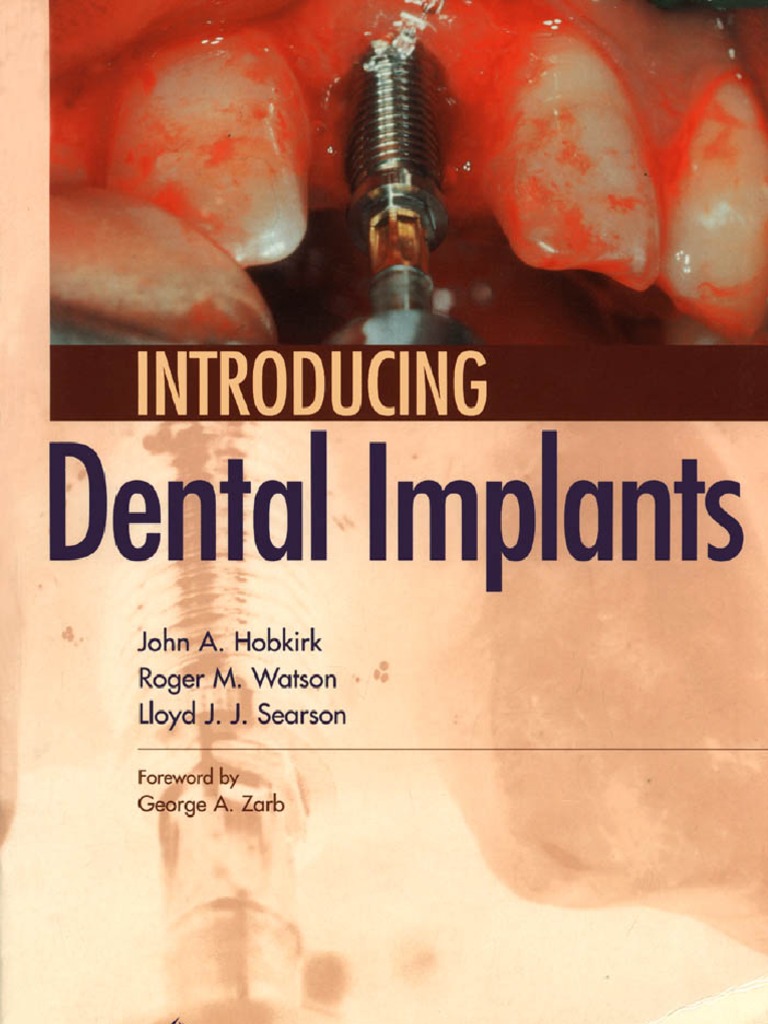 Introduction Dental Implant | PDF | Dental Implant | Human Tooth