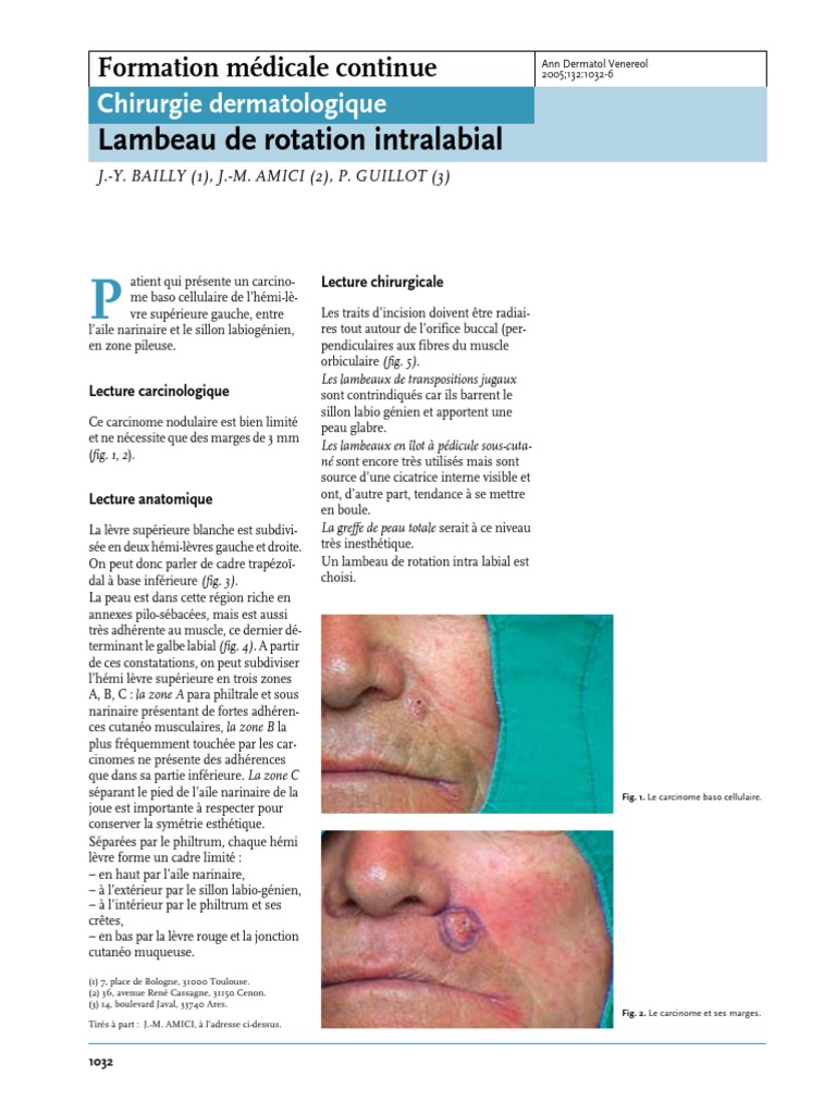 Lambeau de rotation intralabial en chirurgie | PDF | Lèvre | Anatomie ...