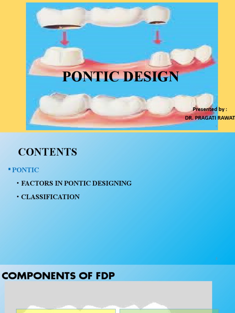 Pontic Design: Presented By: Dr. Pragati Rawat | PDF | Dentistry ...