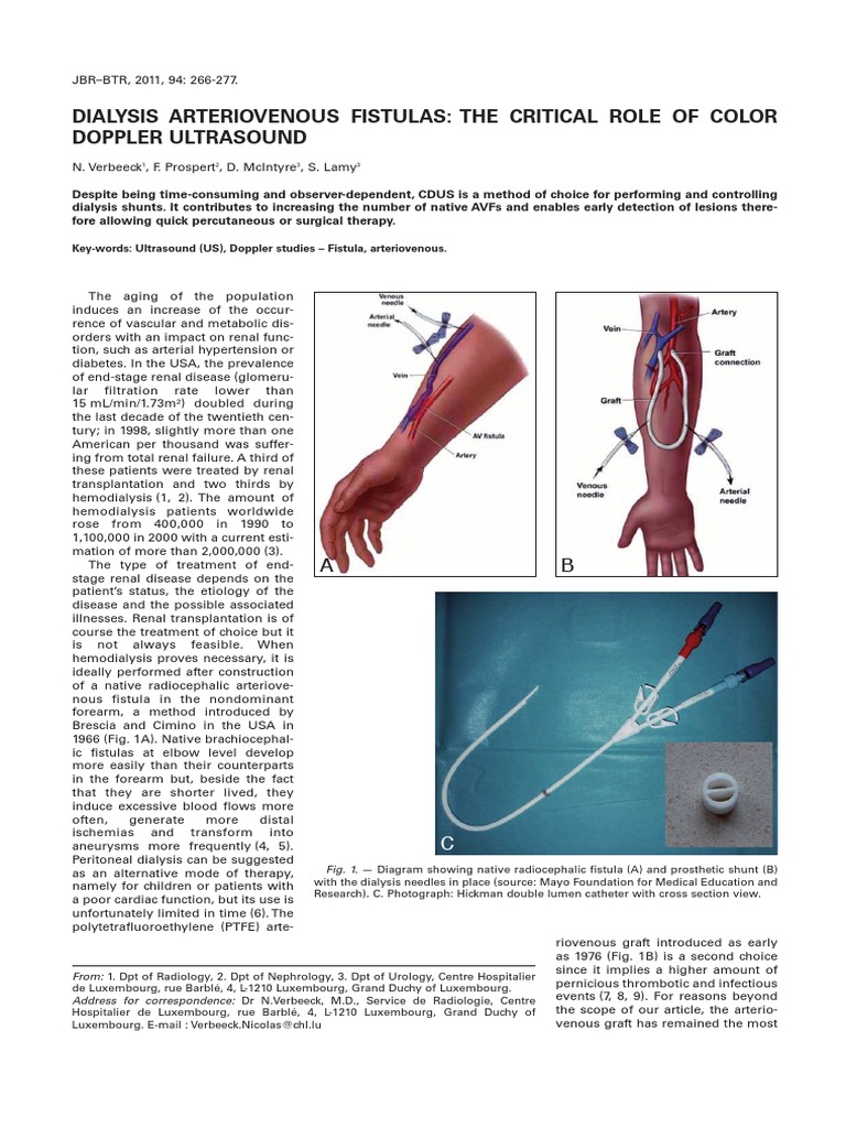 Dialysis Arteriovenous Fistulas The Critical Role | PDF | Hemodialysis ...