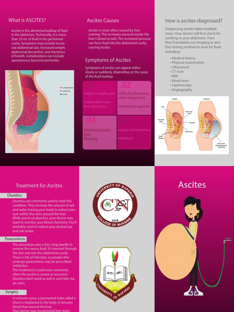 What Is ASCITES? Ascites Causes | PDF | Clinical Medicine | Medical ...