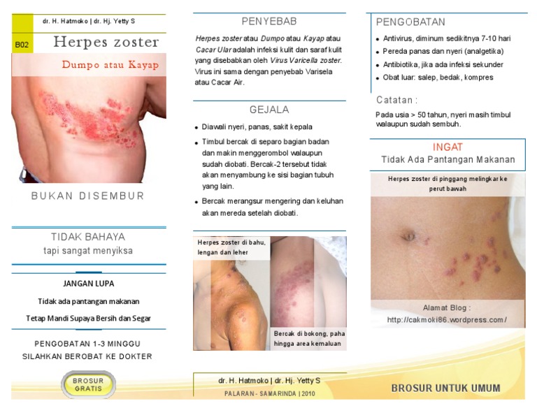 Brochure Herpes Zoster | PDF