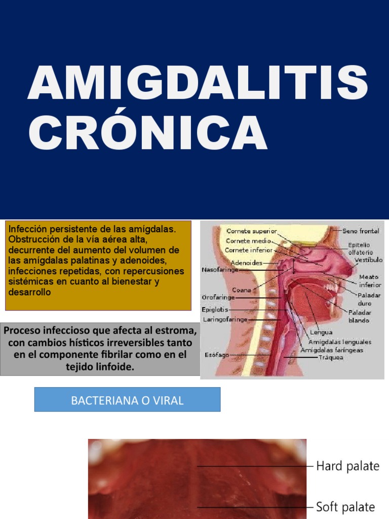 Amigdalitis Cronica | PDF | Especialidades Medicas | Enfermedades y ...