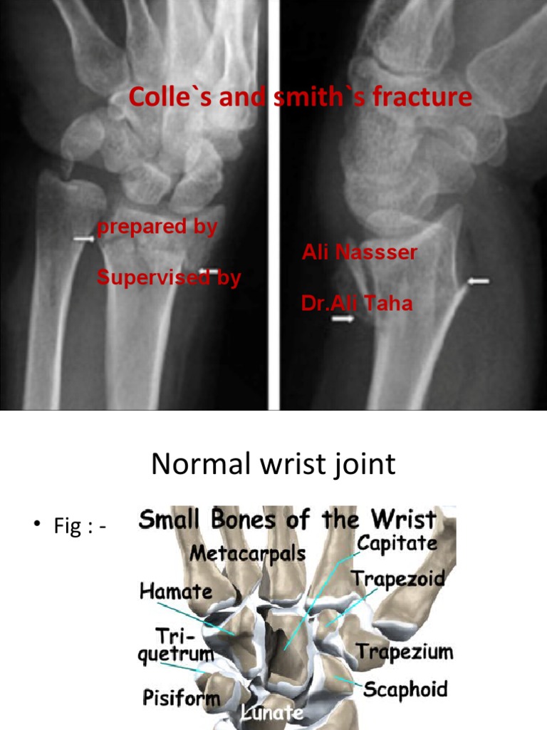 Colles vs Smith Fracture Overview | PDF | Anatomical Terms Of Motion ...