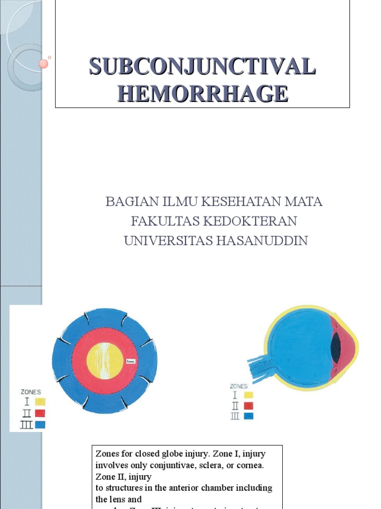 Understanding Subconjunctival Hemorrhage: Causes, Symptoms, Signs, and ...