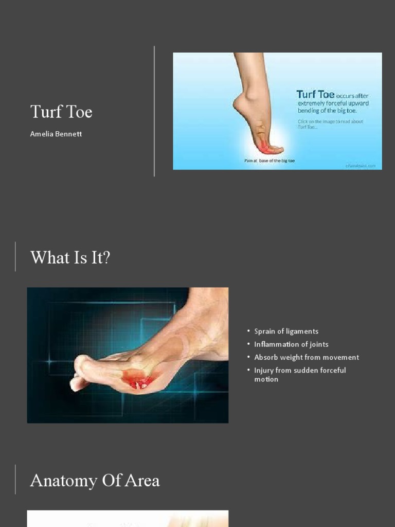 Turf Toe | PDF