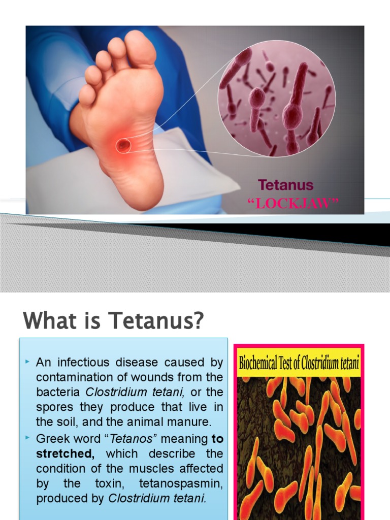 Tetanus | PDF | Clinical Medicine | Medical Specialties
