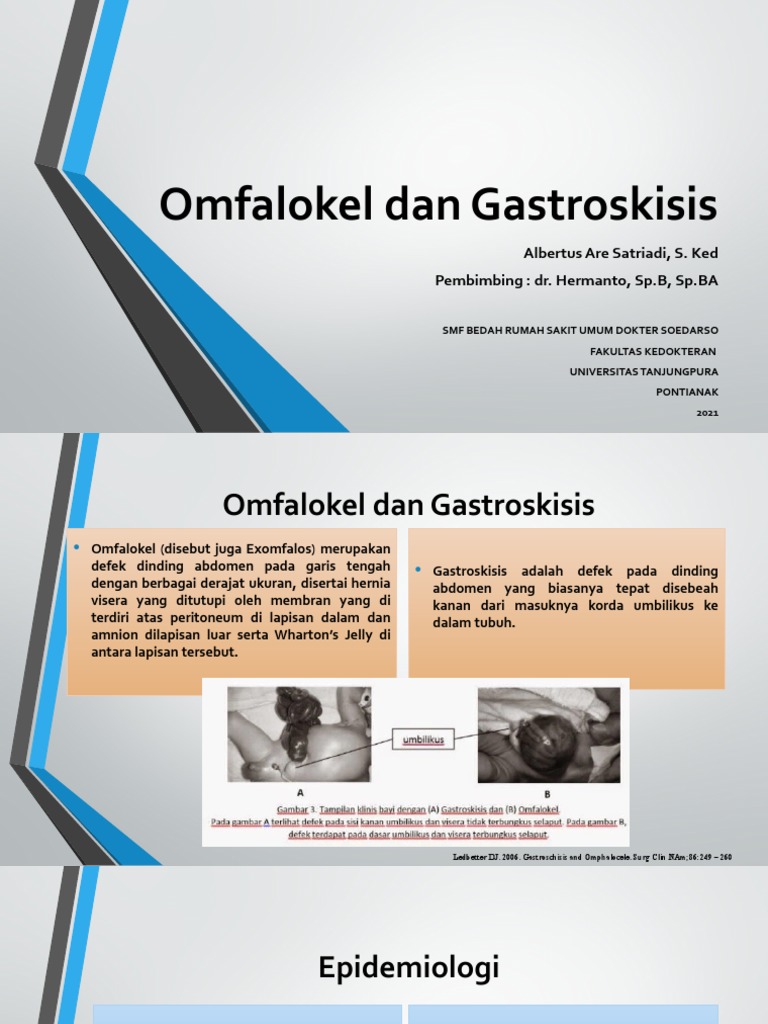 Omfalokel Dan Gastroskisis - Albertus Are Satriadi | PDF