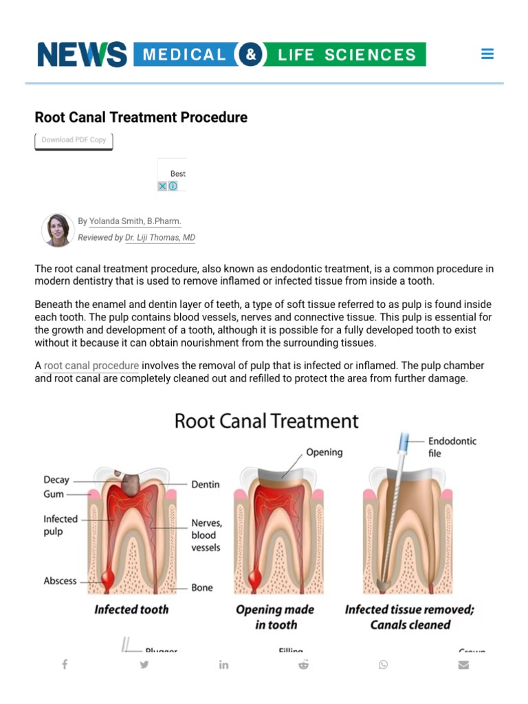 Root Canal Treatment Procedure | PDF | Health Sciences | Medical ...