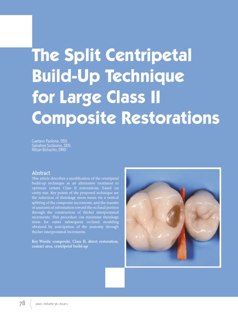 The Split Centripetal Build-Up Technique For Large Class II Composite ...
