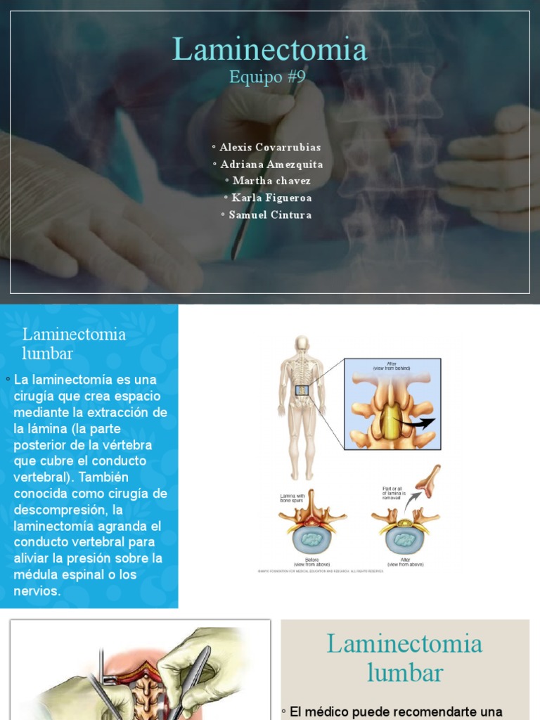 Laminectomia | PDF | Vértebra | La columna vertebral