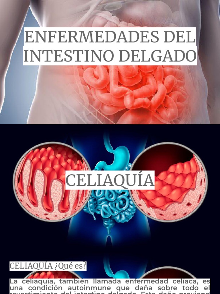 Enfermedades Intestino Delgado | PDF | Enfermedad celíaca | Enfermedad ...