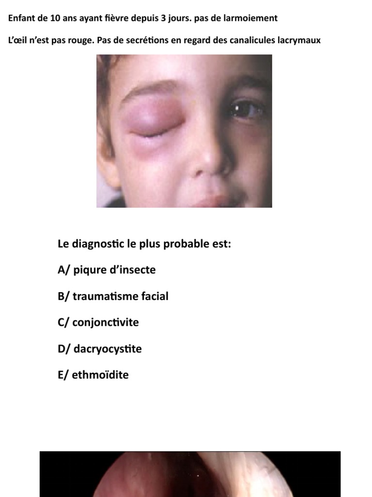 Diagnostic et traitement de l'éthmoïdite | PDF | Développement ...