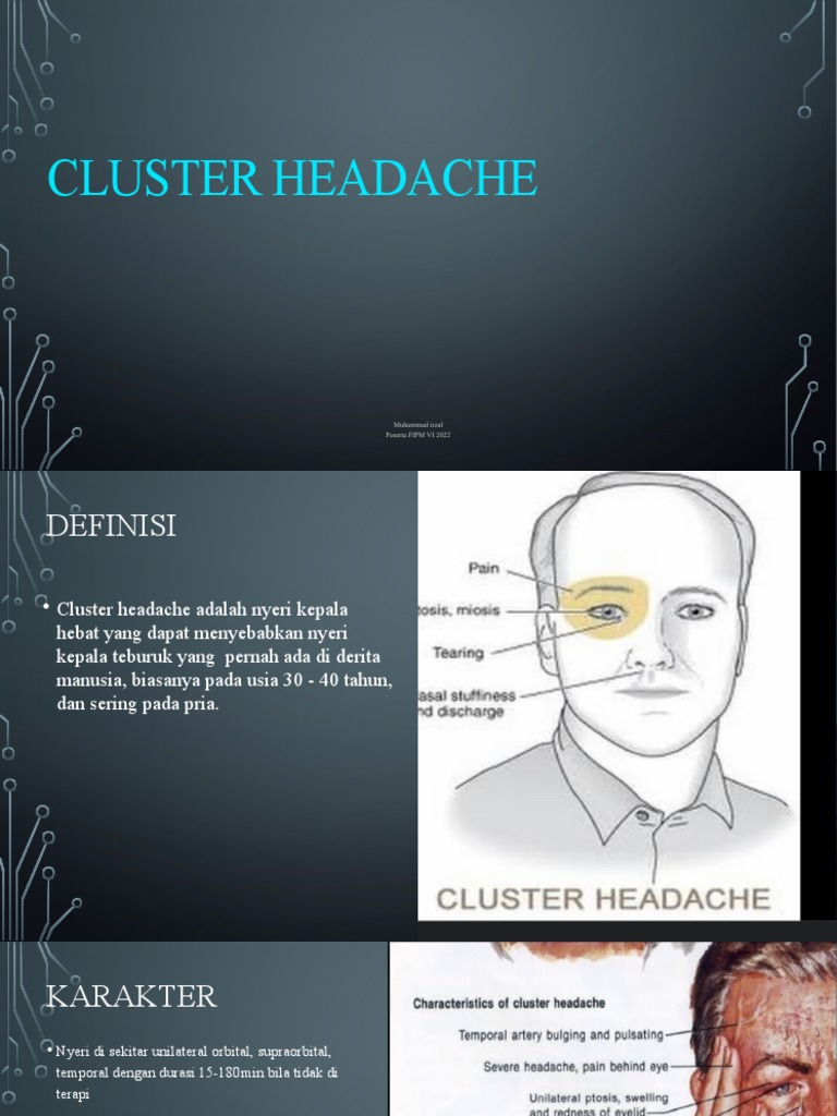 Cluster Headache | PDF