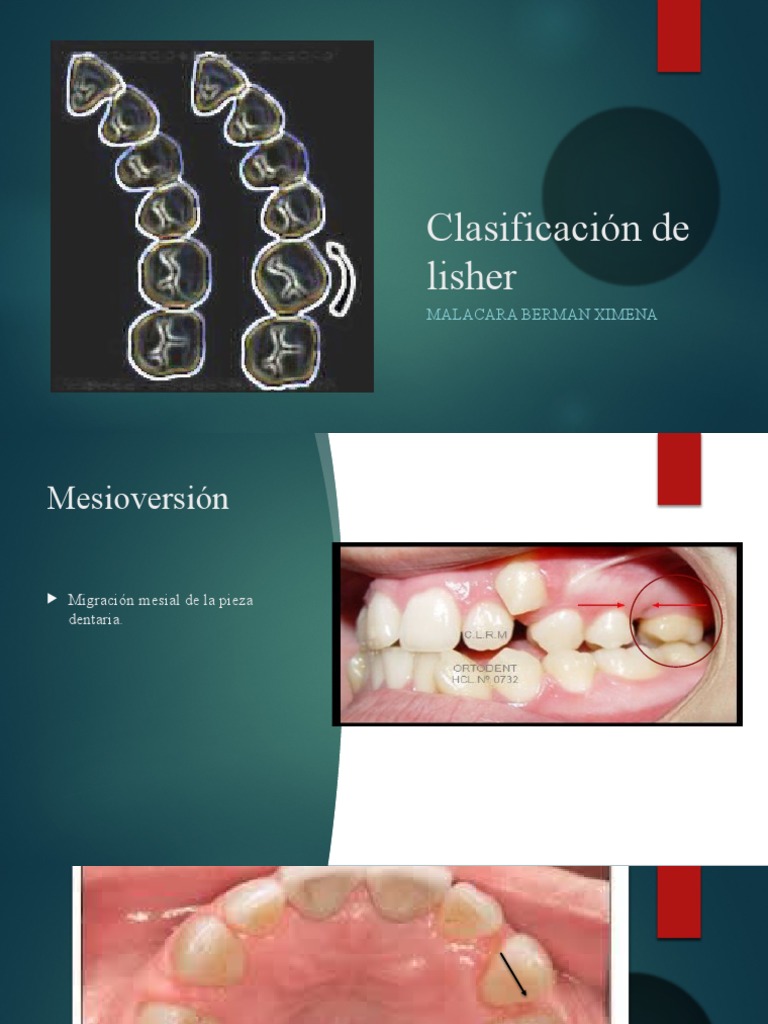 Clasificacion de Lisher | PDF