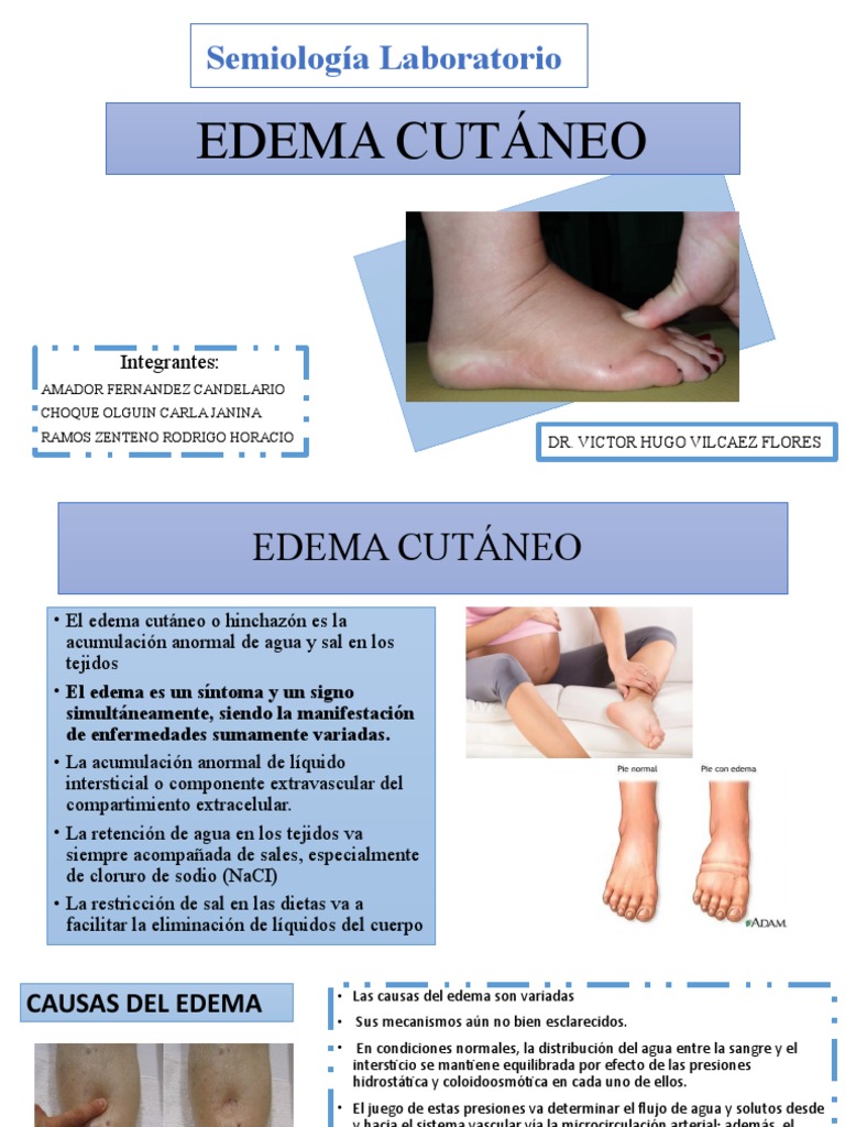 Edemas | PDF | Edema | Medicina CLINICA