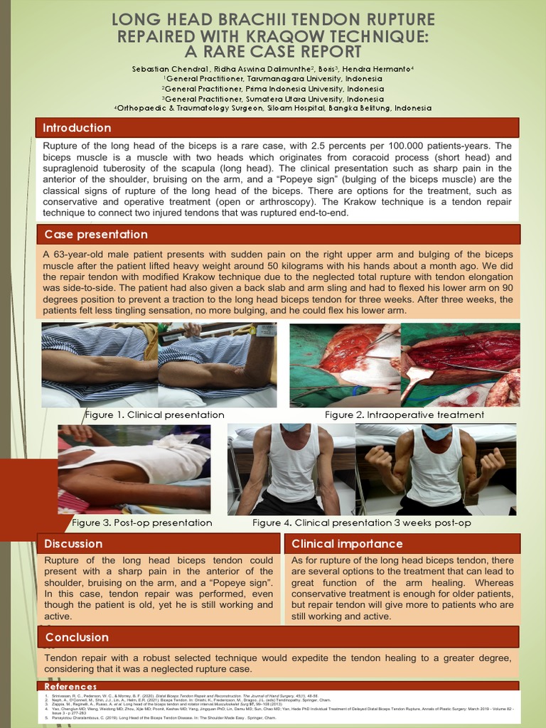 Repair of a Neglected Long Head of the Biceps Tendon Rupture Using the ...