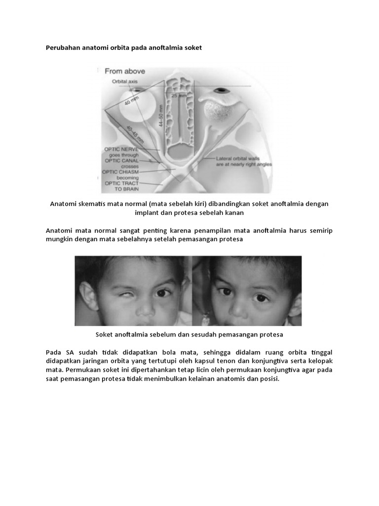 Perubahan Anatomi Orbita Pada Anoftalmia Soket | PDF