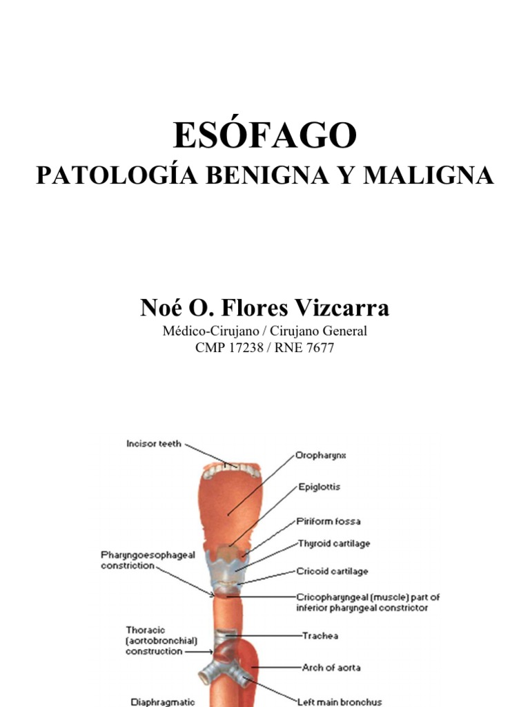 Esofago Patologia Benigna y Maligna | PDF | La enfermedad por reflujo ...