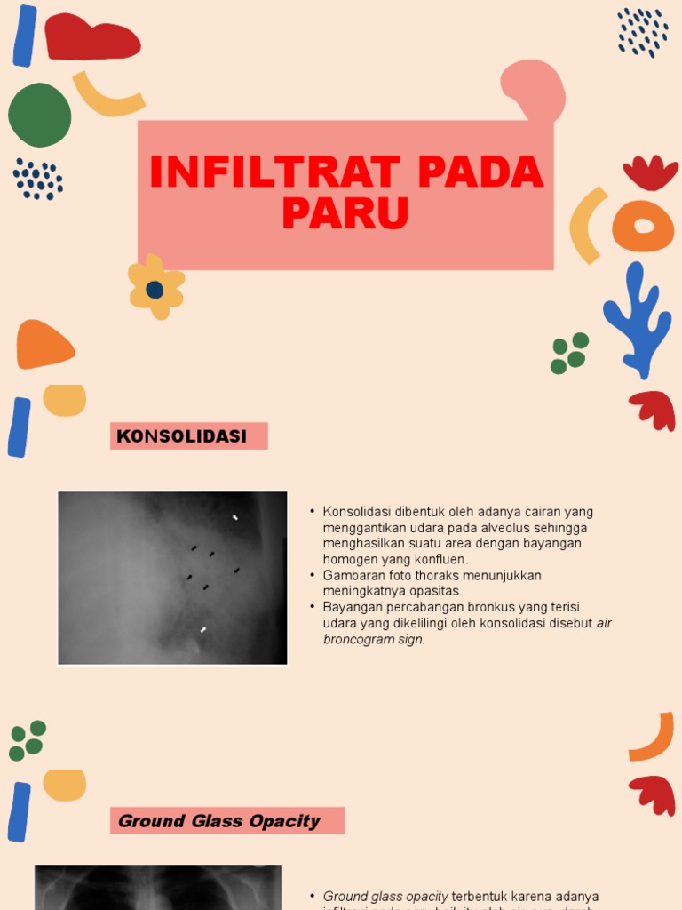 Infiltrat Pada Paru | PDF