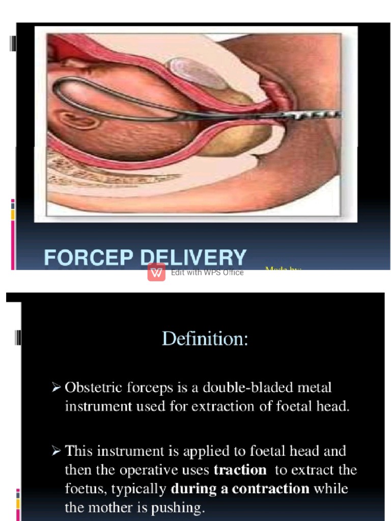 Forcep Delivery | PDF