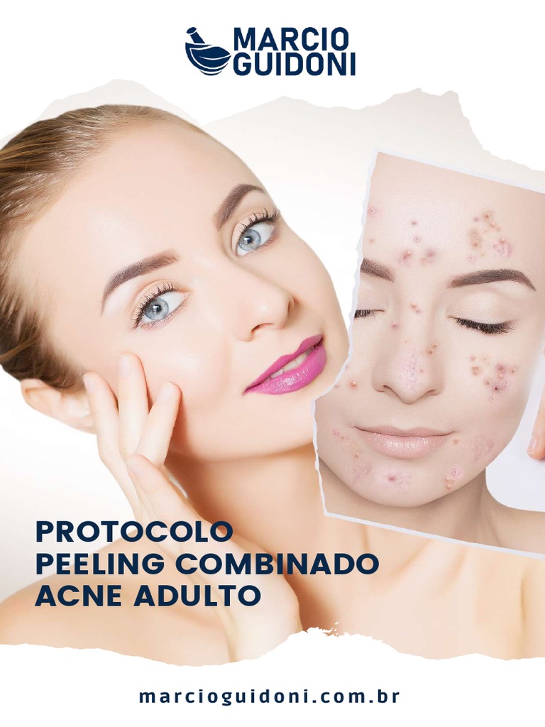 Protocolo Combinado Acne Adulto | PDF | Química | Substancias químicas