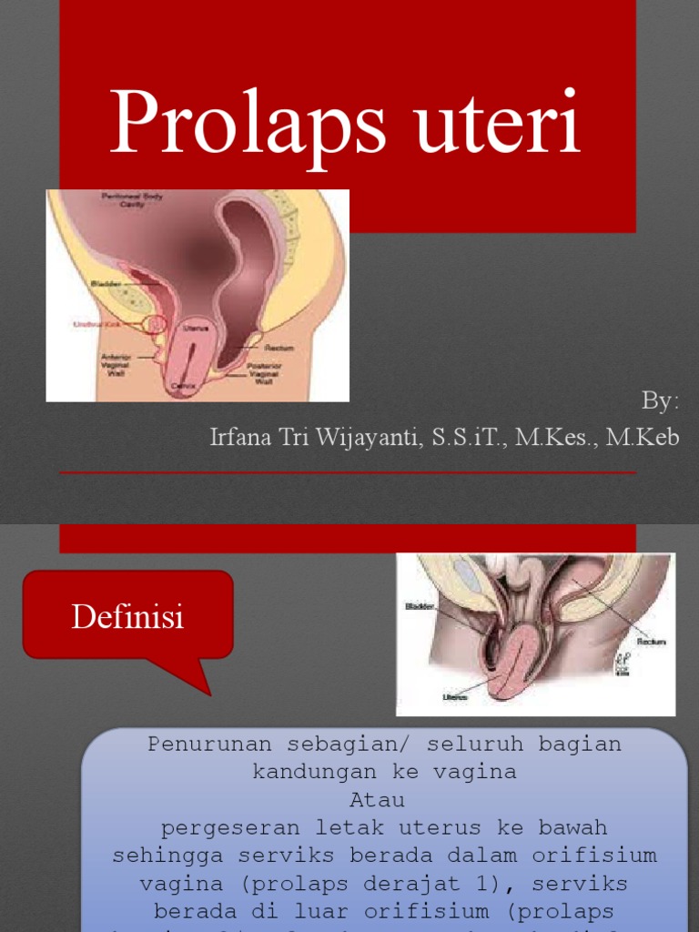Prolaps Uteri | PDF
