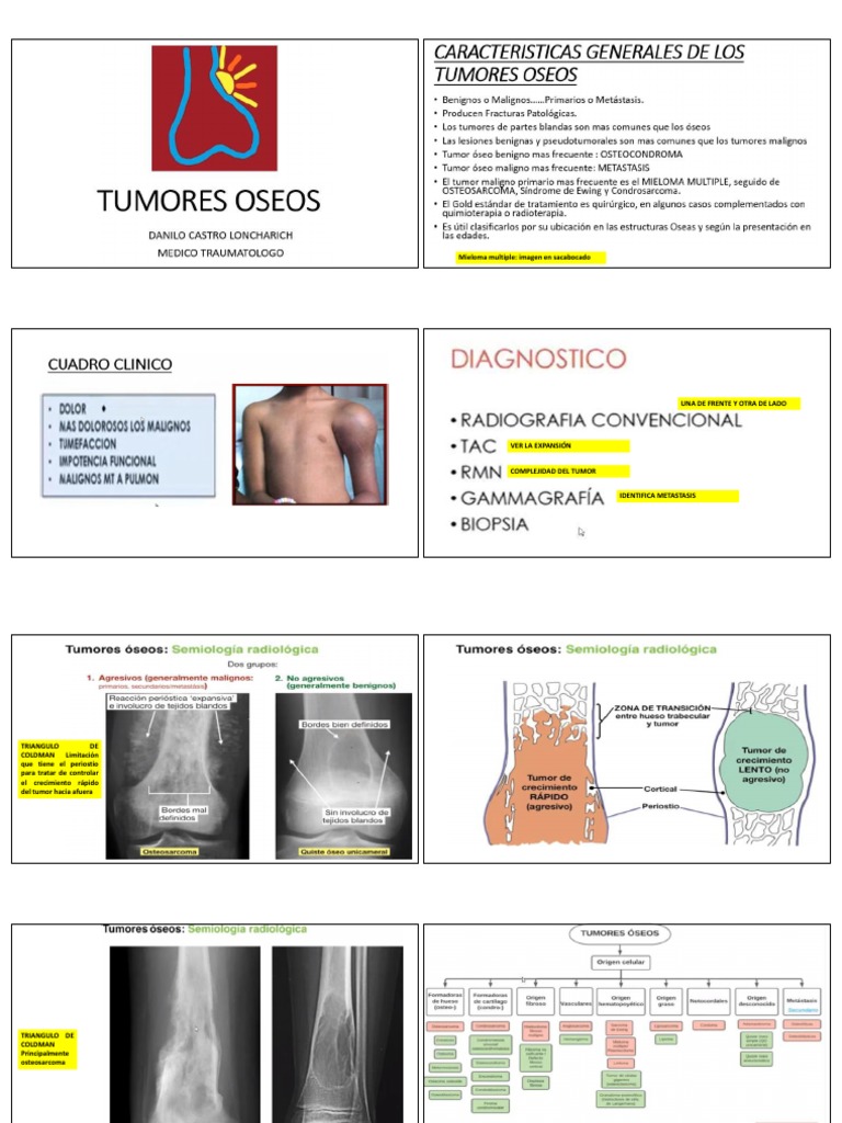 Tumores Oseos | PDF | Neoplasias | Hueso