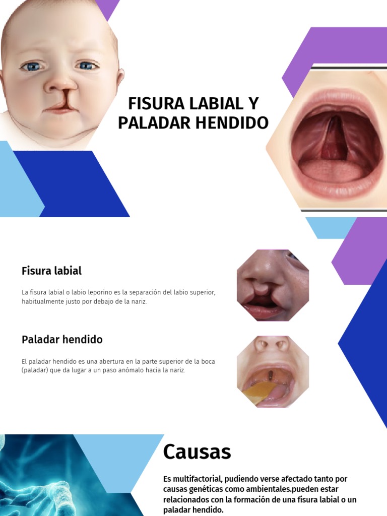Paladar Hendido y Fisura Labial | PDF | Medicina CLINICA ...