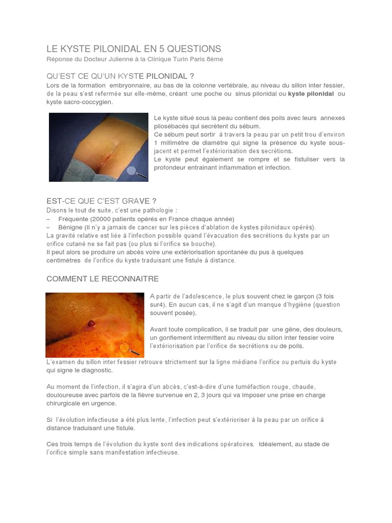 Le Kyste Pilonidal en 5 Questions | PDF | Infection | Chirurgie