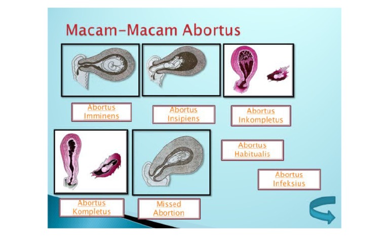 Gambar Macam Abortus | PDF